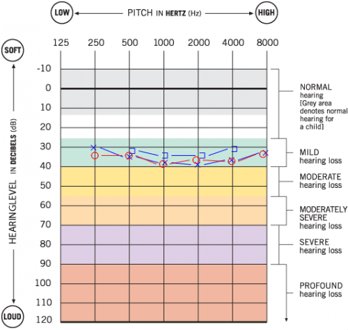 Degrees of Hearing Loss | Happy Ears Hearing Center