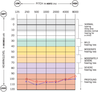 Degrees of Hearing Loss | Happy Ears Hearing Center