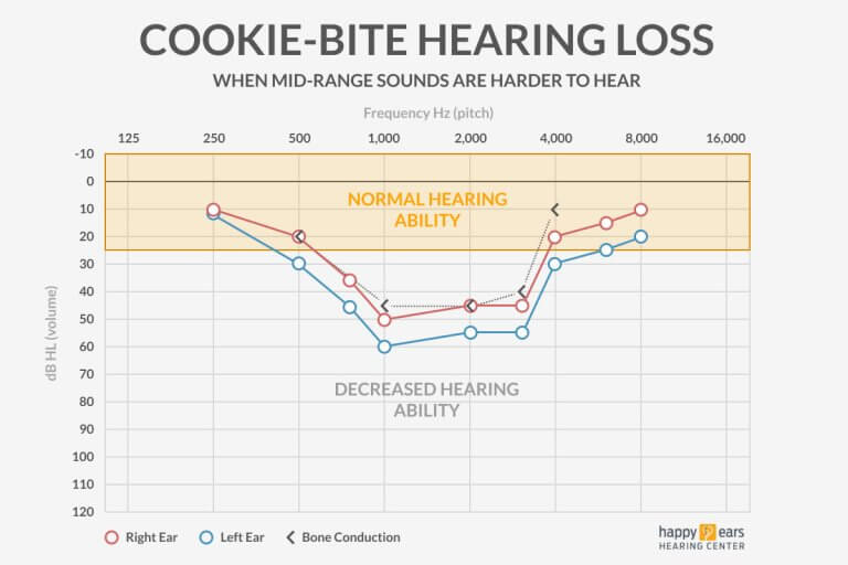 Cookie Bite Hearing Loss: Causes, Symptoms, and Treatment